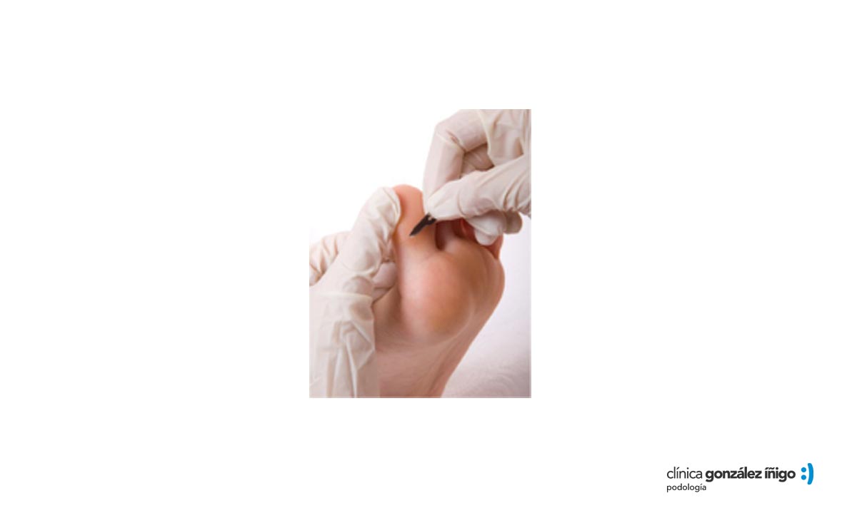 Quiropodia - Clínica podológica González IñigoClínica podológica ...